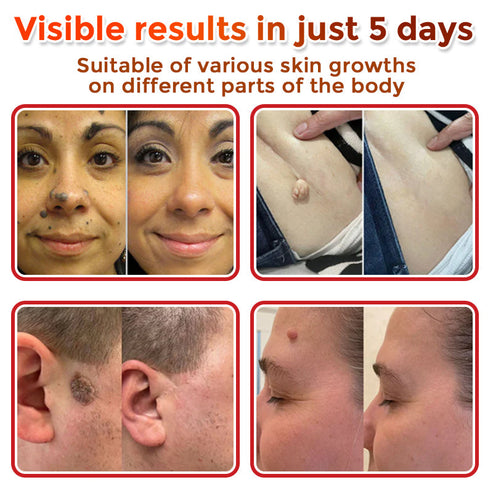 The MicroDerm Patch - Painless Skin Tag & Blemish Removal + 50% OFF ...