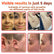 The MicroDerm Patch - Painless Skin Tag & Blemish Removal + 50% OFF ...