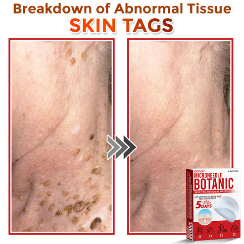 The MicroDerm Patch - Painless Skin Tag & Blemish Removal + 50% OFF ...