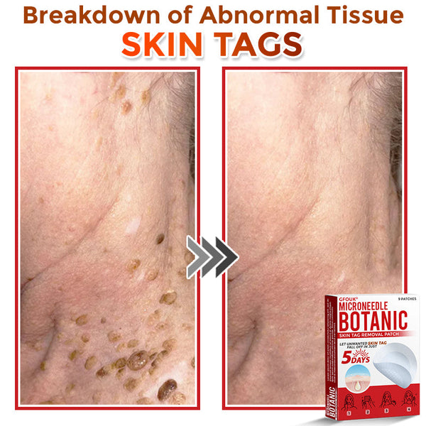 The MicroDerm Patch - Painless Skin Tag & Blemish Removal + 50% OFF ...